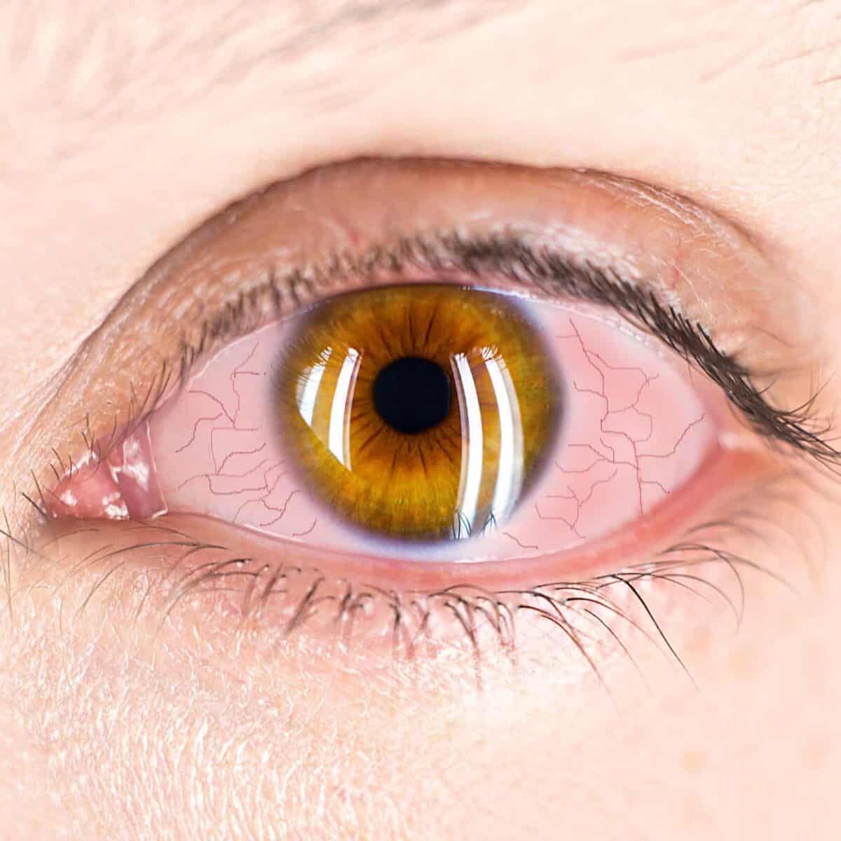 Uveitis: Ocular Inflammation | Weber Vision Care